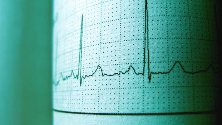 Understanding Heart Palpitations: Causes, Symptoms & Treatment